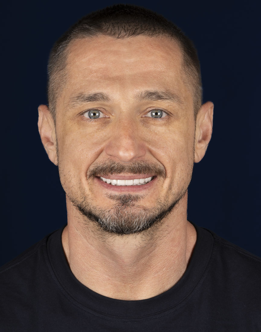 Results Gallery | All on Four, Implants, BL3 Veneers | Happy Smile