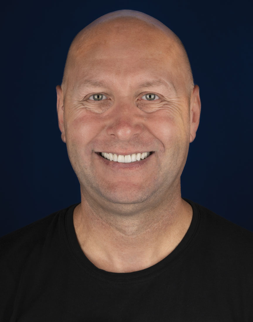 Results Gallery | All on Four, Implants, BL3 Veneers | Happy Smile